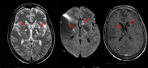 Soap Bubble Lesions Cryptococcus Neoformans In Brain