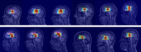 Interpretable Simultaneous Localization Of Mri Corpus Callosum And Classification Of Atypical