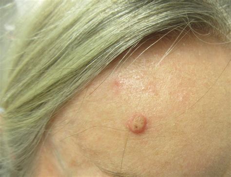 Basal Cell Carcinoma On Forehead Bcc Image Example Mr Tehrani