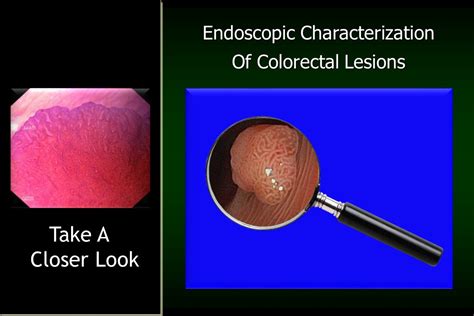 Pit Pattern Classification Colon Explorer