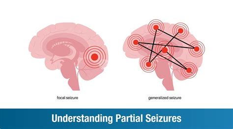 Understanding Partial Seizures Types Symptoms Causes And Treatment Options Plexus