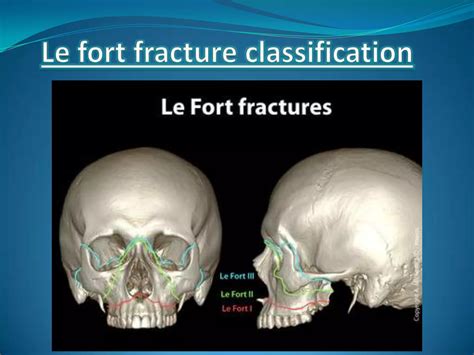 Le Fort Fracture 2 Pptx