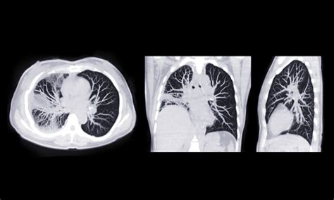 Tomografía Computarizada De Tórax O Pulmón Axial Coronal Y Sagital Vista Mip De Infección ...