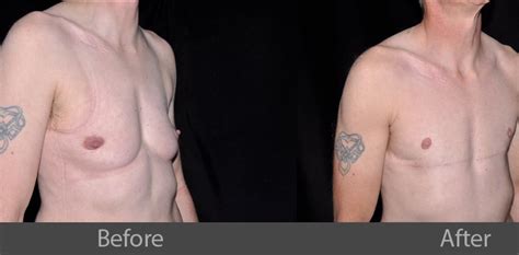 Sex Change Male To Female Before And After Pics