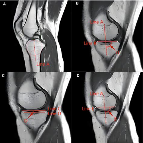 Figure 1 From Increased Lateral Femoral Condyle Ratio Measured By Mri