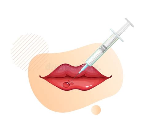Botulinum Toxin Injection On Lips Stock Illustration Stock Illustration Illustration Of