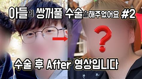 진짜 잘 됐을라나 아들 쌍꺼풀 수술을 직접 해주면 생기는 일 Youtube