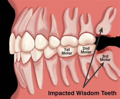Hygienists Blog Local Anesthesia Vs General Anesthesia For Wisdom