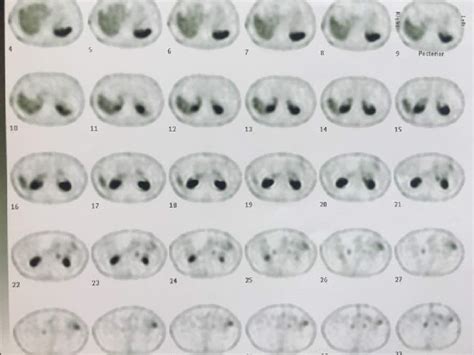 Acromegaly Case Study Present Illness A 57 Year