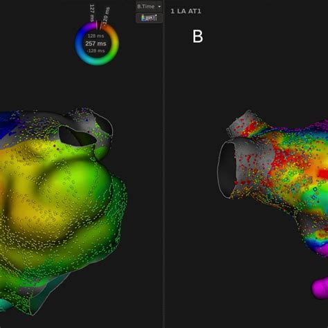 Electroanatomic Mapping Of The Left Atrium Performed With The Pentaray Download Scientific