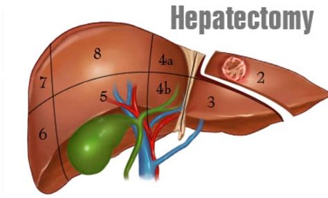 Doctorsdiarty — A Hepactectomy Is The Surgical Removal Of The