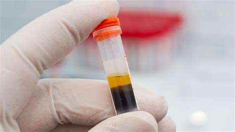 Association Of Sodium Correction Rates For Hyponatremia With Mortality Docwire News