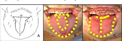 Figure 1 From The Efficacy Of The Partial Glossectomy For Prevention Of