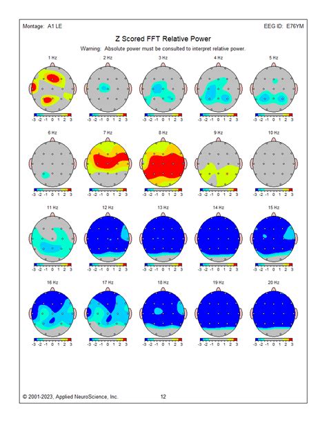 A Guide To Interpreting Eeg Topographic Maps
