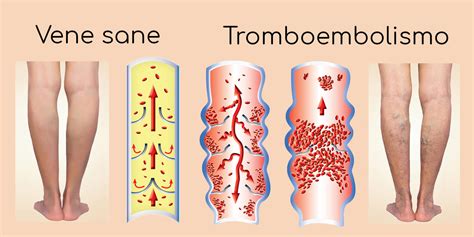 Insufficienza Venosa Alle Gambe Sintomi Rimedi E Cura Valori Normali