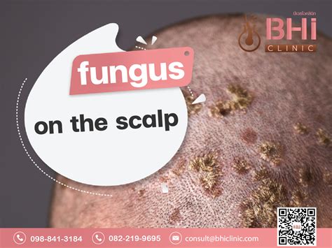 Fungus On The Scalp Bhi Clinic