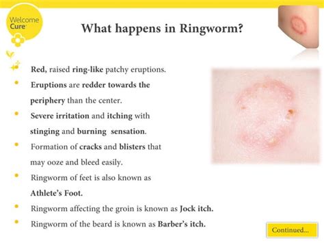 Treating Ringworm Infection Achieving Flawless Skin With Homeopathy Ppt