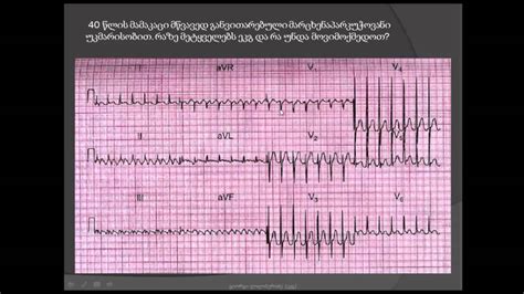 ეკგ გულის მწვავე მარცხენაპარკუჭოვანი უკმარისობა წინაგულთა თრთოლვა F ტალღები ფლეიკაინიდი