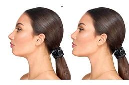 What Are The Different Types Of Chin Implants In Islamabad Price