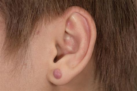 Understanding Keloids And Their Connection To Piercings What You Need