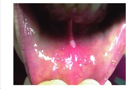 Oral Aphtous Lesion In A Patient With Ha20 Written Informed Consent