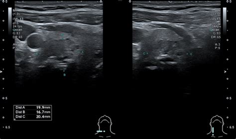 Hypoechogenic Ovoid Smooth Non Homogeneous Solid Thyroid Nodule With Download Scientific