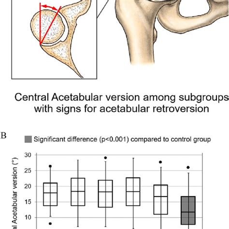 The Acetabular Retroversion Index Is Calculated By Dividing Bc By Ab Download Scientific