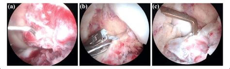 Arthroscopic Findings During Surgery A The Avulsed Fragment At The Download Scientific