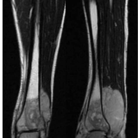 Mri Showing Osteosarcoma At The Left Distal Tibia Download