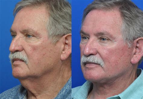 Facelift Post Procedure Jacksonville Fl Ponte Vedra Beach Facelift