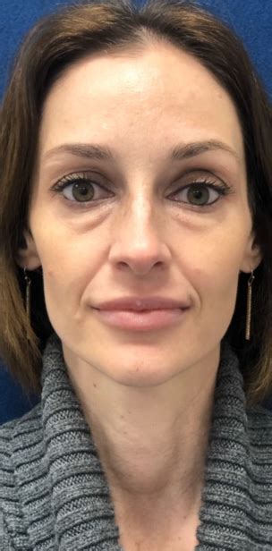 Juvederm Cheeks Before And After Photos