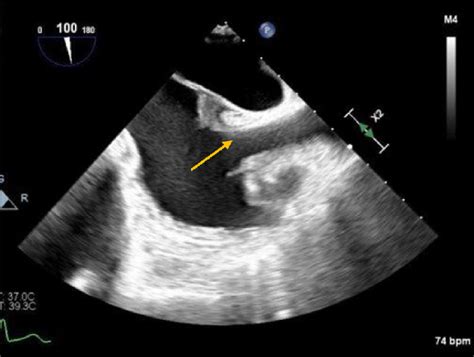 Cardiac Mass In The Atrial Septum At The Right Atrialsuperior Vena Cava Download Scientific