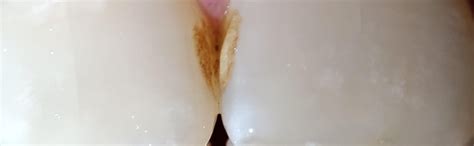 Is This Staining Between My Upper Front Teeth And Or Caries I Drink