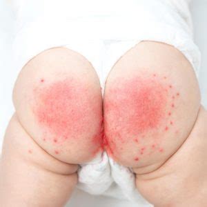 Types Of Diaper Rash Pictures Identify And Treat