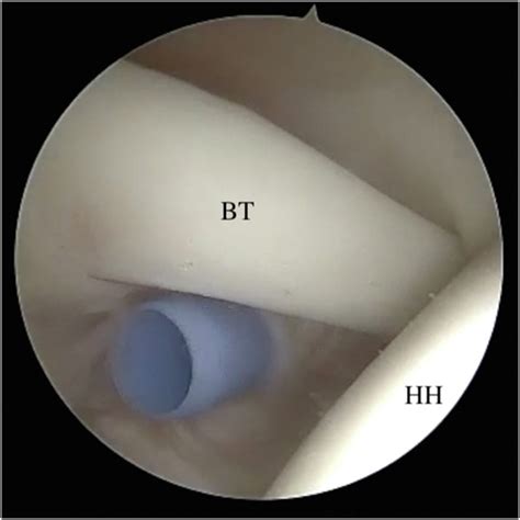 Arthroscopic In Situ Biceps Tenodesis Using A Double Loop And Tack