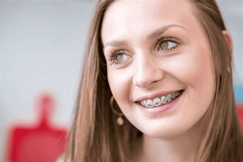Braces Removal Process What To Expect Damon Orthodontics