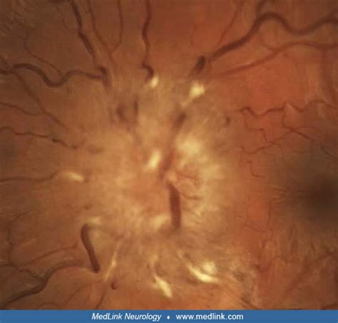 Unilateral Papilledema