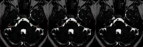 Trigeminal Neuralgia Secondary To Minor Size Lesion Anatomical