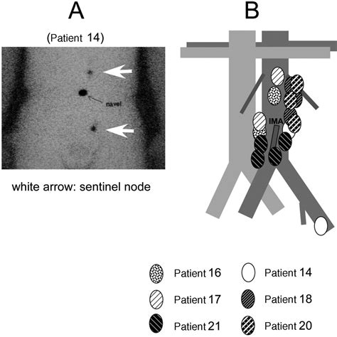 Intraoperative Radio‐guided Sentinel Lymph Node Mapping In Laparoscopic Lymph Node Dissection