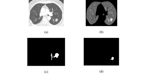 an example for solid nodule image taken from lidc idri a input