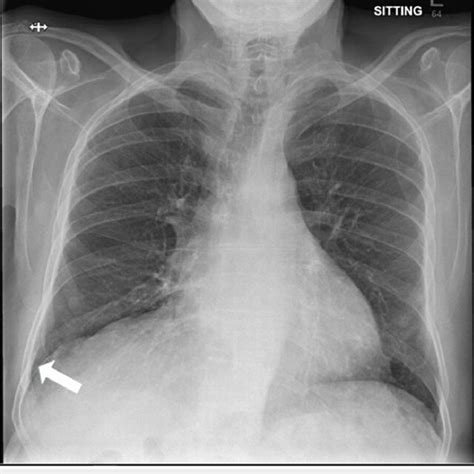 Chest X Ray From October 2020 Showing Right Lower Lobe Consolidation Or