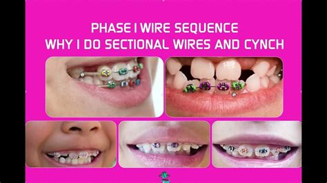 Phase 1 Braces Wire Sequence Cynch Sectional Wires Youtube