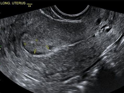 Endometrial Polyp Home Private Gynaecology