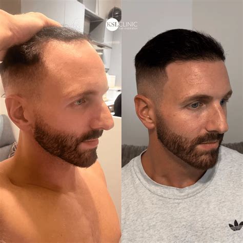 Whats The Difference Between A Mature And Receding Hairline Ksl Clinic
