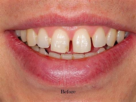 how to get rid of gaps in teeth with braces how to get rid of gaps in