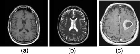 Figure 1 From Intelligent Detection Of High Grade Brain Tumor With