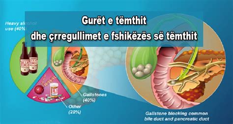 Gurët E Tëmthit Dhe çrregullimet E Fshikëzës Së Tëmthit Mjekesia Bimore Arabe