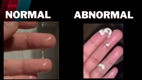 Discharge Normal And Abnormal Ones And What They All Mean Youtube