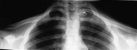 Postoperative Radiograph At One Year The Open Medial Physis Is On The