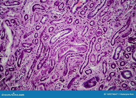 Diffuse Proliferative Glomerulonephritis Stock Image Image Of Microphotograph Medicine